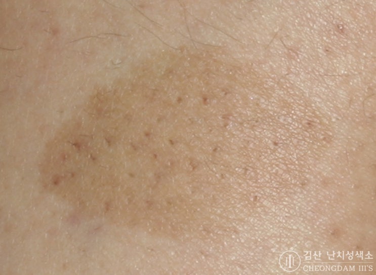 반문상 모반(Nevus Spilus):Speckled lentiginous Nevus : 네이버 블로그
