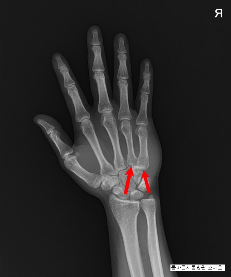 유구골 골절과 동반된 4,5 중수골 골절 탈구에서의 고정술(ORIF at 4,5 th MC fracture dislocation ...