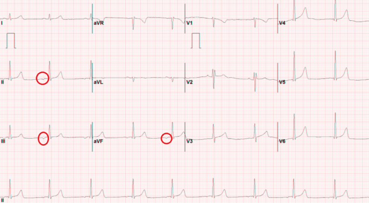 심계항진과 동반된 호흡곤란 (답답하다)으로 내원한 사례, inverted P wave(뒤집힌 P파), 이소성 심방 리듬 ...
