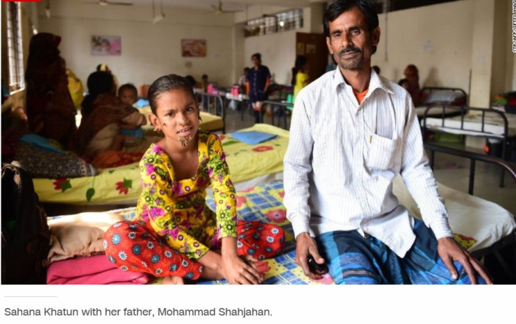 나무인간 증후군 ----'tree man' syndrome : 네이버 블로그