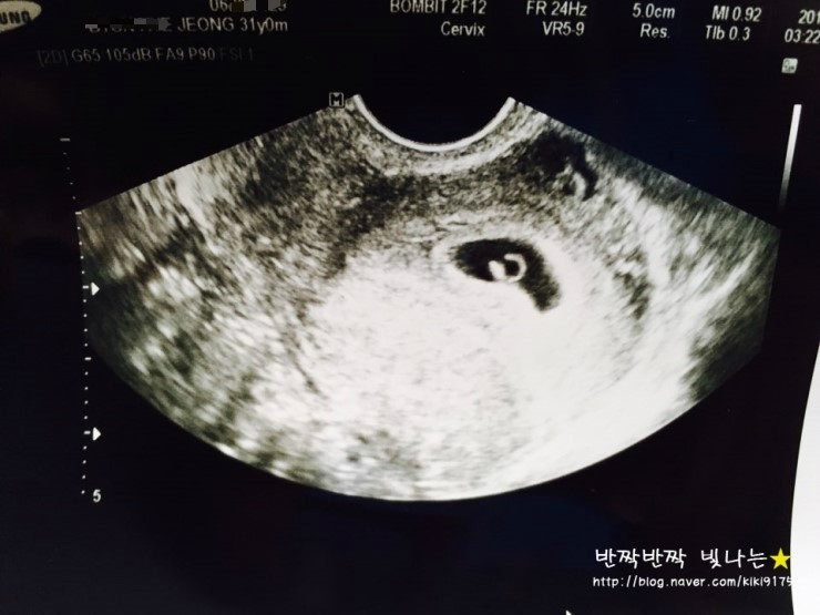 임신 5주 6주 초음파로 아기집 난황 아기까지 확인하기♡ 덤으로 아기심장소리까지~ 네이버 블로그