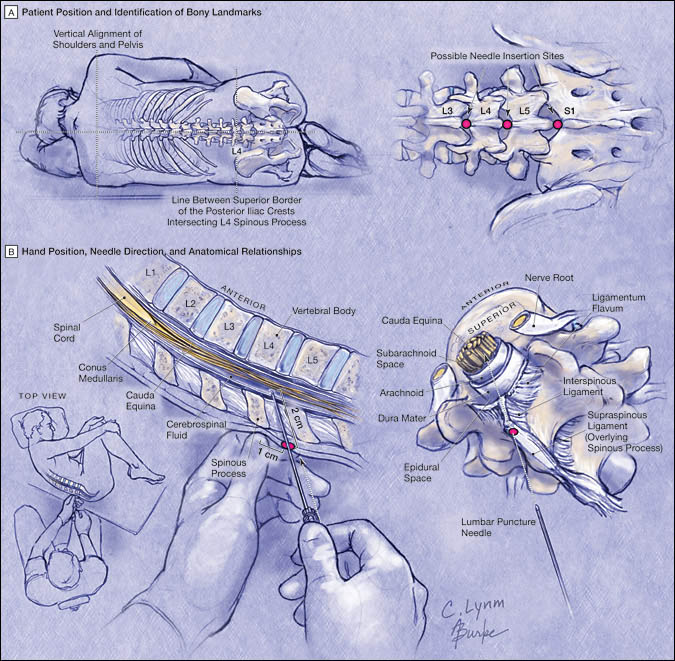 척추 천자(Spinal tapping, lumbar puncture) 와 뇌척수액 검사(CSF study) : 네이버 블로그