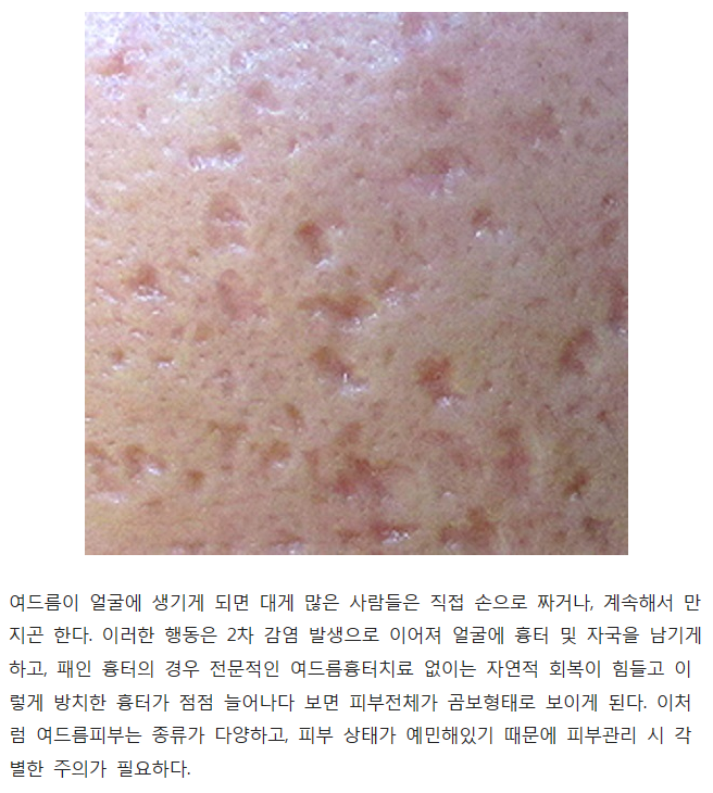 프락셀듀얼 포함한 유클리닉 에어프락셀 여드름흉터 제거·치료 도움돼 네이버 블로그