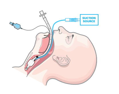 subglottic suctioning : 네이버 블로그