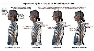 FOUR TYPES OF POSTURAL ALIGNMENT (3. FLAT - BACK POSTURE) : 네이버 블로그
