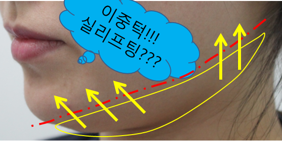 실크하트 이중턱실리프팅이 생소하죠? : 네이버 블로그