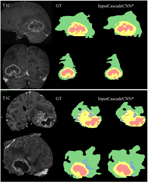 Brain tumor segmentation with Deep Neural Networks : 네이버 블로그