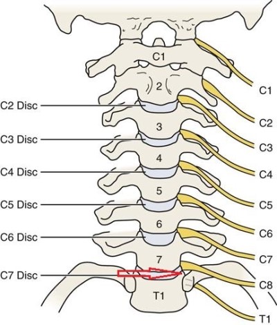 C7/T1 경추 디스크 탈출증에 의한 손가락 마비 증상 : 네이버 블로그