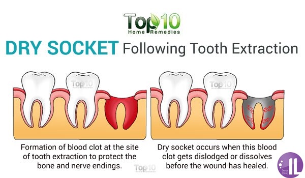 구리 치과//드라이 소켓 - 사랑니 발치의 후유증 : 네이버 블로그