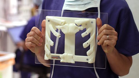 3D printed sternum and rib implant : 네이버 블로그