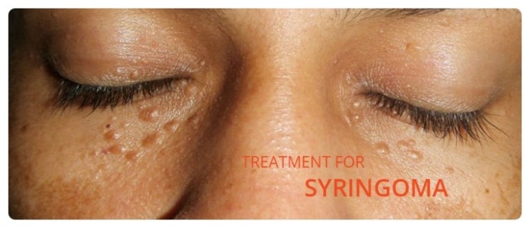 [피부외과학] 한관종(Syringoma)의 특징 : 네이버 블로그