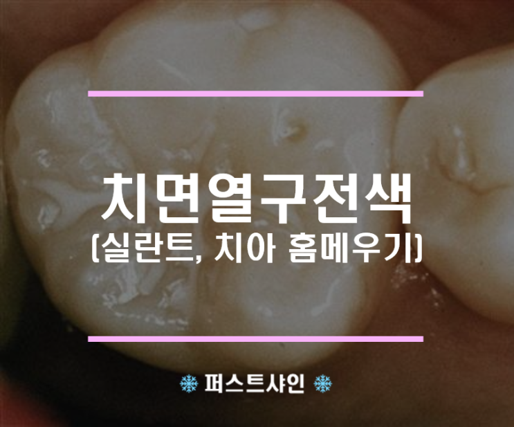 구강관리 충치예방을 위한 치면열구전색 실란트 치아 홈메우기 네이버 블로그