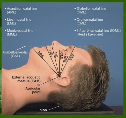 Caldwell view, PNS 엑스레이 : 네이버 블로그