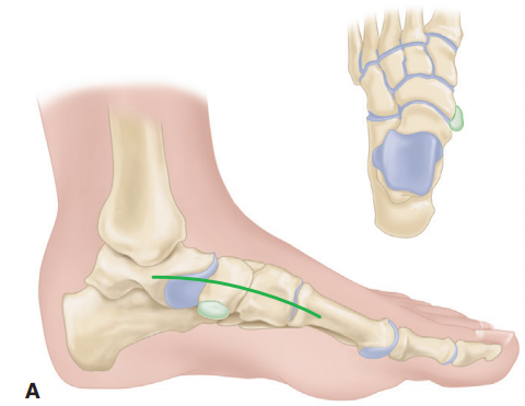 Kidner procedure : 네이버 블로그