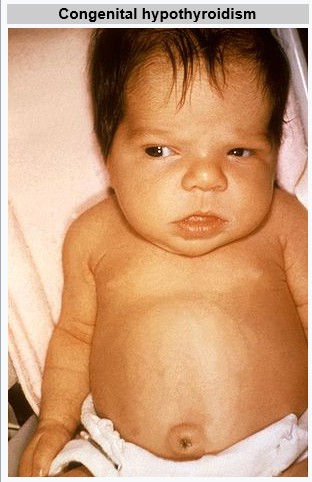 congenital hypothyroidism(선천성 갑상선 저하증) : 네이버 블로그
