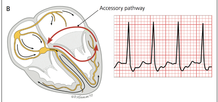 PSVT, AV reentrant tachycardia(AVRT), 조기흥분증후군(Preexcitation syndrome ...