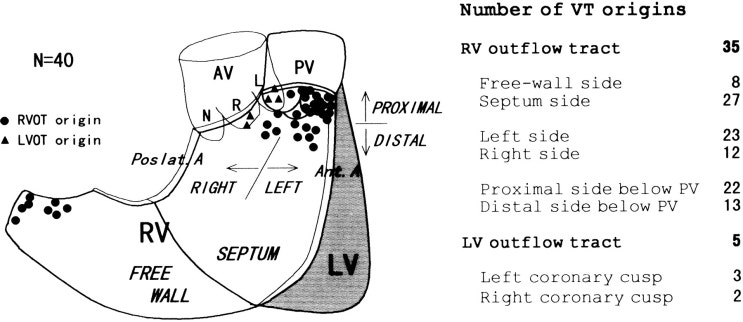 Idiopathic Ventricular tachycardia, RVOT VT, Fascicular (or LV septal ...