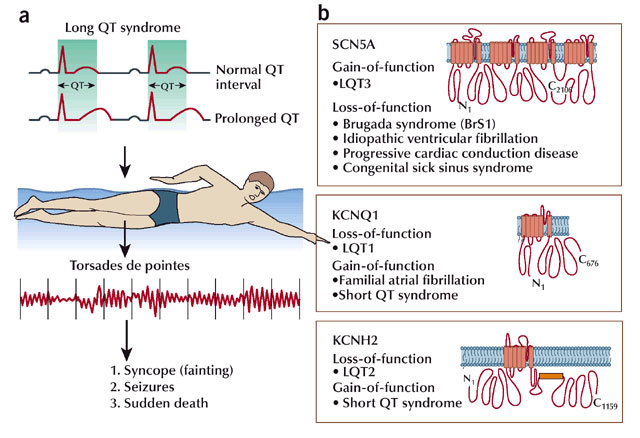 Polymorphic VT (PMVT), PMVT with normal QT, Torsade de Pointes ...