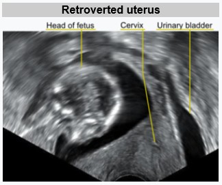retroverted uterus : 네이버 블로그