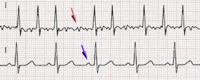 Atrial fibrillation (심방세동) : 네이버 블로그