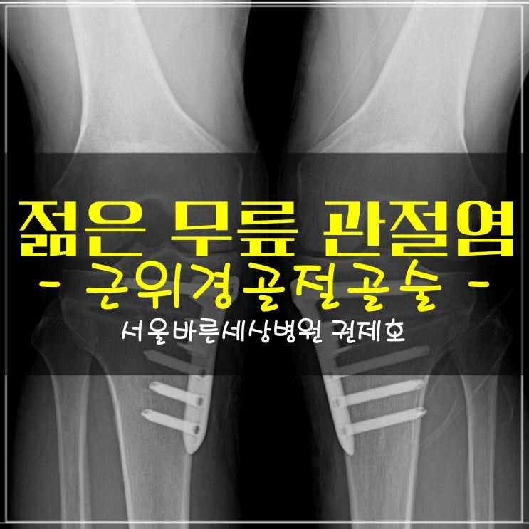 젊은 나이에 무릎 관절염 근위 경골 절골술이 답 제이본정형외과 권제호 네이버 블로그