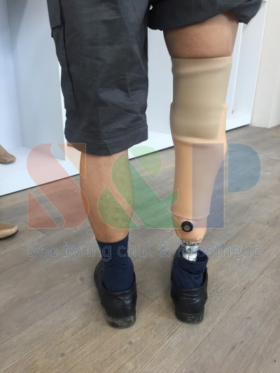 긴 환부무릎밑절단에 제작완성된 실리콘형 보행용 하퇴의족오서의족가격서병철의족에스앤피의족케어센터 네이버 블로그