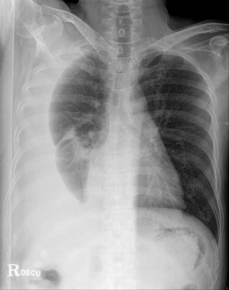 Chest Decubitus : 네이버 블로그