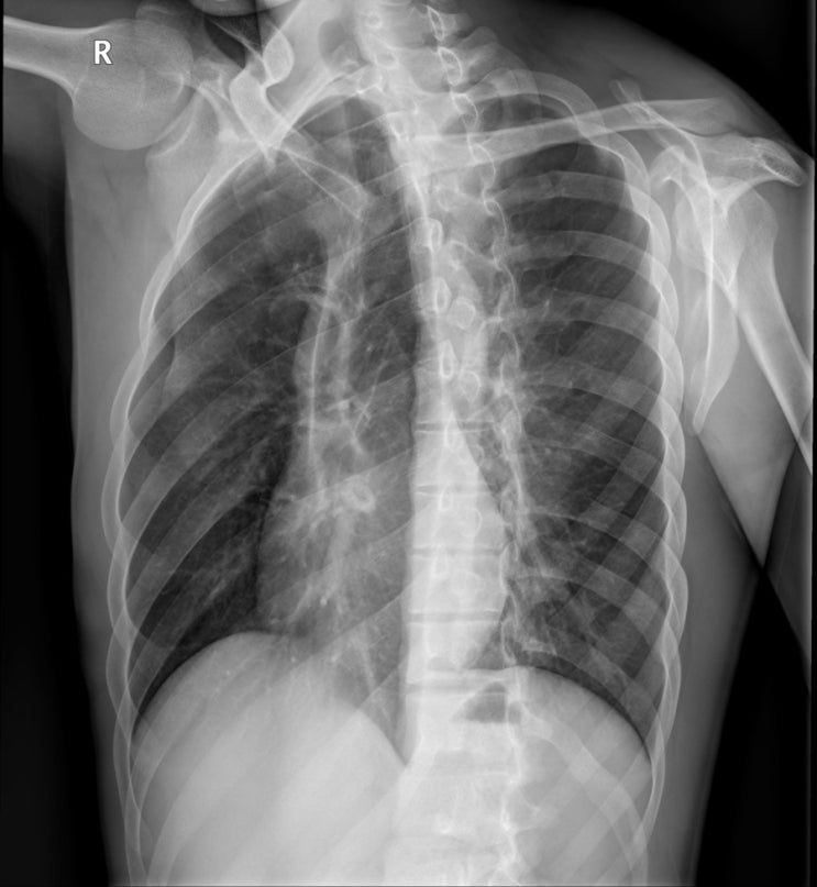Rib oblique(both) : 네이버 블로그