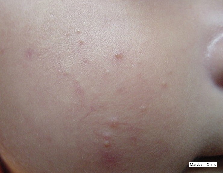 3. 영아여드름(Acne infantum) ﻿[요약] - 제33장. 여드름(痤瘡, Acne) ﻿- 한국에 흔한 피부질환 [개정판 ...