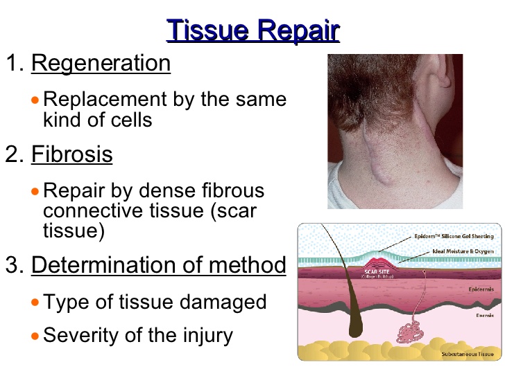 조직 수복 (tissue repair) : 네이버 블로그