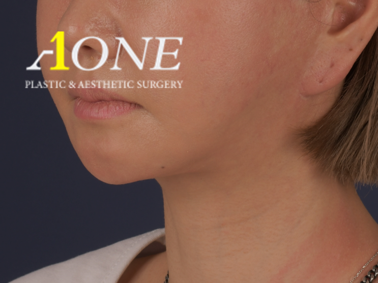 무서운 안면윤곽술_Terrifying Facial Bone Contouring Surgery : 네이버 블로그