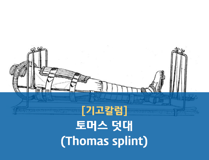 [기고칼럼] 토머스 덧대(Thomas splint) - 골절된 넓적다리 뼈 안전하게 고정...출혈 줄어 사망률 '뚝' : 네이버 블로그