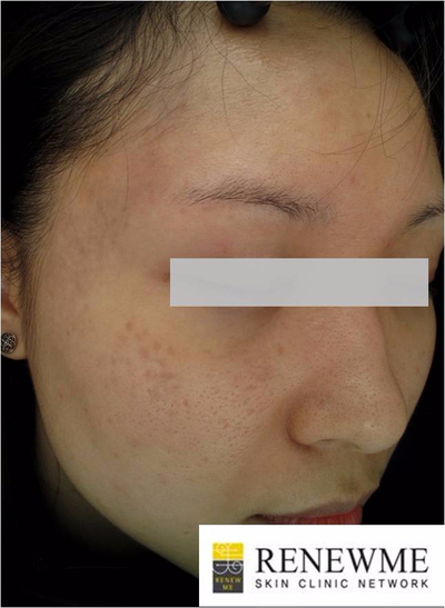 [분당 오타양모반] ABNOM, 양측성오타양모반 치료 사례, 리뉴미피부과 : 네이버 블로그