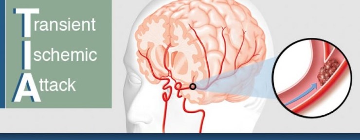 일과성 허혈발작(TIA, transient ischemic attack) : 네이버 블로그