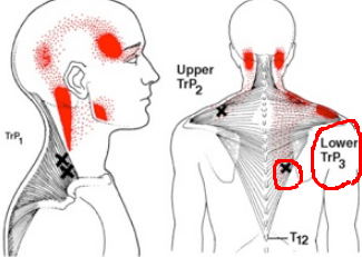 하부승모근 섬유(lower trapezius fibers)TrP3 : 뒷통수 아래, 어깨바깥쪽 통증 : 네이버 블로그