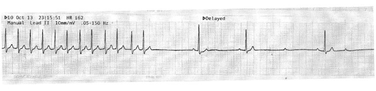 심장이 두근 심박수 180회 - PSVT? : 네이버 블로그