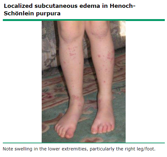 IgA 혈관염, 발진, IgA vasculitis (Henoch-Schönlein purpura), rash : 네이버 블로그