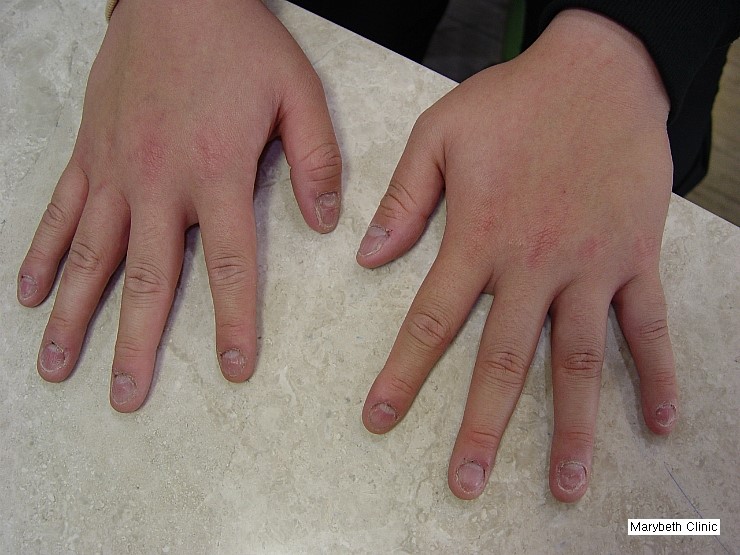 4. 손발톱이상증(爪甲異營養症, Onychodystrophy) [요약][진단][치료] 제26장. 손발톱장애(爪甲障礙, Nail ...