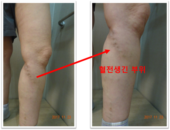 다정 흉부외과 어느 날 갑자기 다리 통증이 생긴다면 혈전 정맥염 의심 네이버 블로그