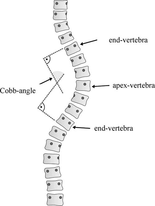 Cobb's angle 이란? : 네이버 블로그