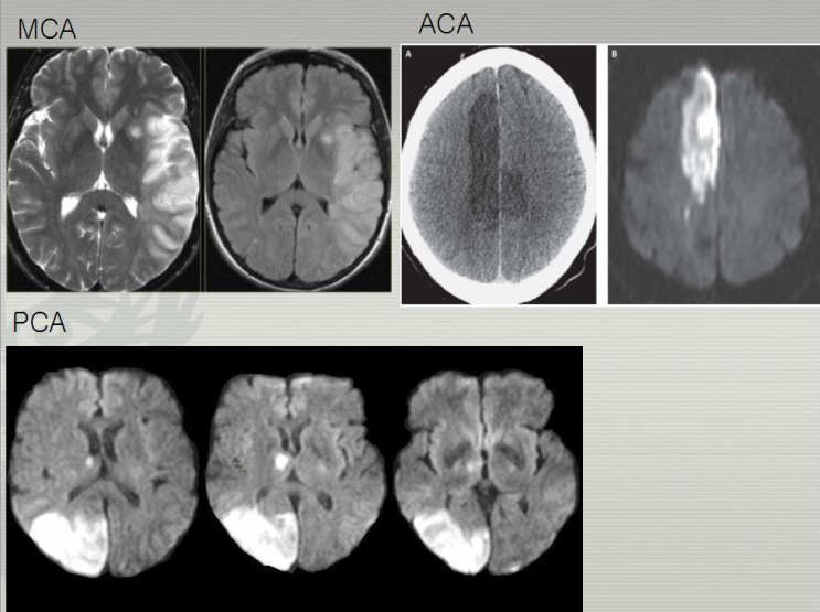 뇌경색의 MRI imaging : Diffussion, ADC map, Perfusion(MTP,TTP) : 네이버 블로그