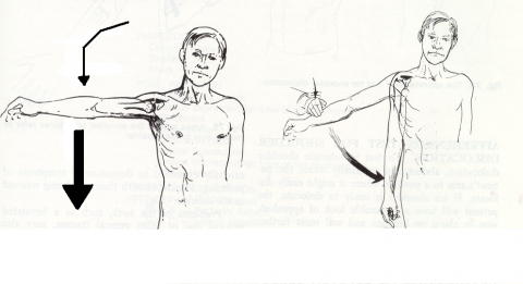 팔 떨어뜨리기 검사(drop arm test) / 어깨관절의 특수검사(Special test) / 극상근 / 몸편한재활의학과 ...