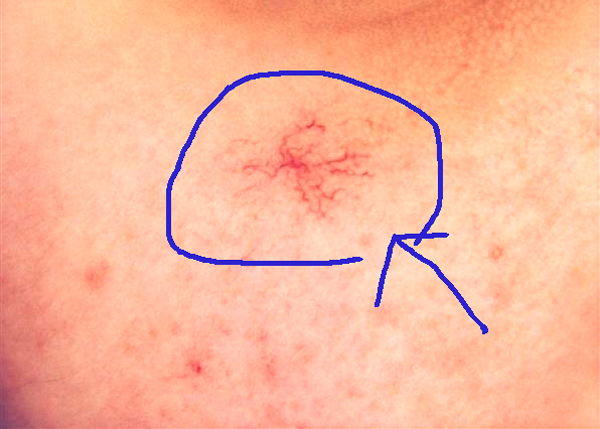 거미모반(spider nevus) : 네이버 블로그