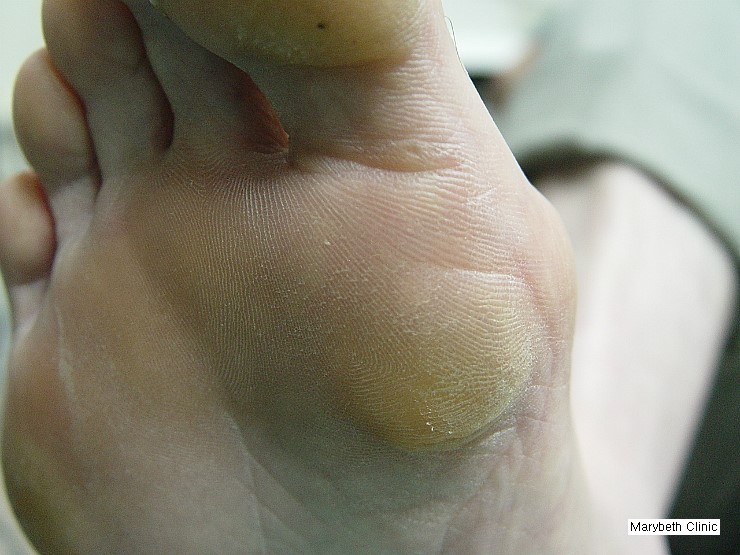 제29장. 티눈 및 굳은살( Corns and callosities) [요약][진단][치료] - 한국에 흔한 피부질환 [개정판 ...