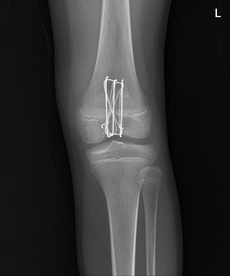 소아의 슬개골 견열 골절에서의 최소침습 긴장강선 고정술(mini invasive ORIF with tension band ...