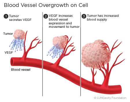 암의전이-혈관신생 Angiogenesis : 네이버 블로그