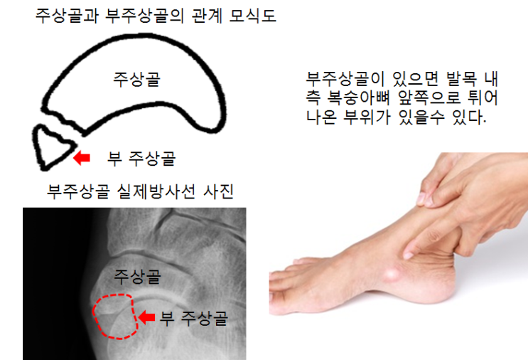 부주상골 증후군 1 발목 내측이 아픈데 발목 안쪽에 뼈가 하나 더 있다구요 족부 정형외과 전문의 김지범 네이버 블로그