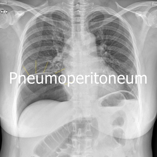 pneumoperitoneum : 네이버 블로그