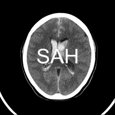 SAH [subarachnoid hemorrhage] : 네이버 블로그