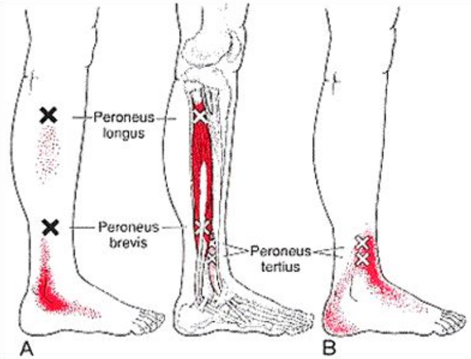 원인모를 발목 통증 !? : 네이버 블로그